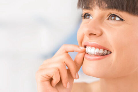 Clear Aligners - Success Smiles Orthodontics