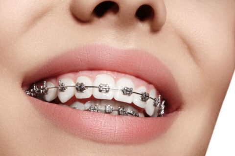 Home - Success Smiles Orthodontics